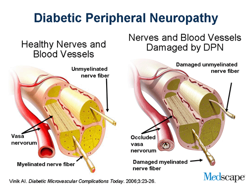 The Four Types of Diabetic Neuropathy - Dr. Michael A. Castillo, MD